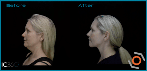 MyEllevate - A minimally invasive "facelift" | Broomfield Med Spa
