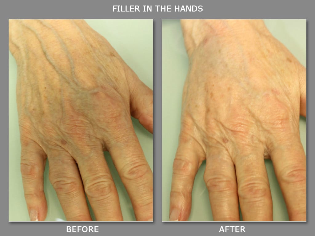 After Care Instructions for Dermal Fillers in Denver| Sonata