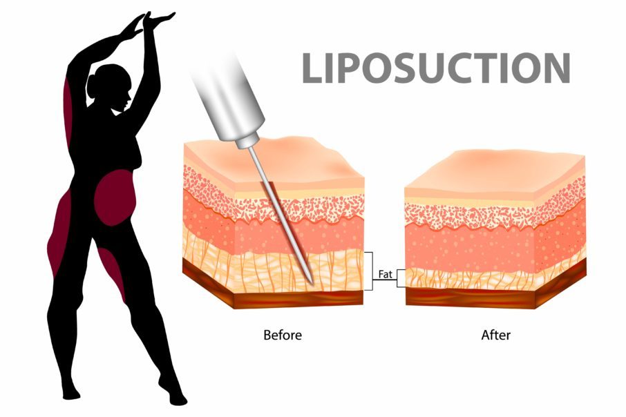 How Does Liposuction Work? | Sonata Aesthetics