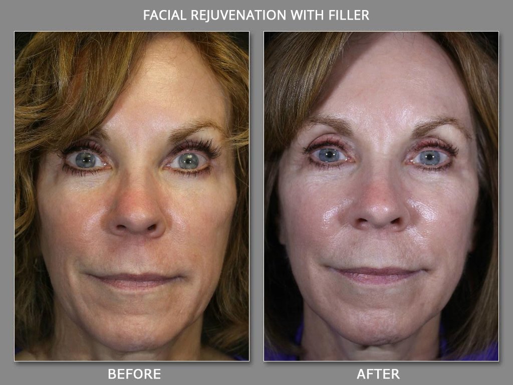 Short Term and Long Term Fillers | Denver & Broomfield Dermal Fillers