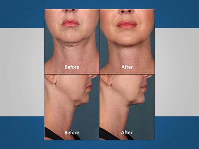Getting Rid of Your Double Chin | Denver and Broomfield Beauty