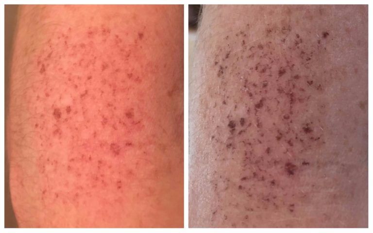 IPL for your body? | Med Spa | Louisville | Colorado