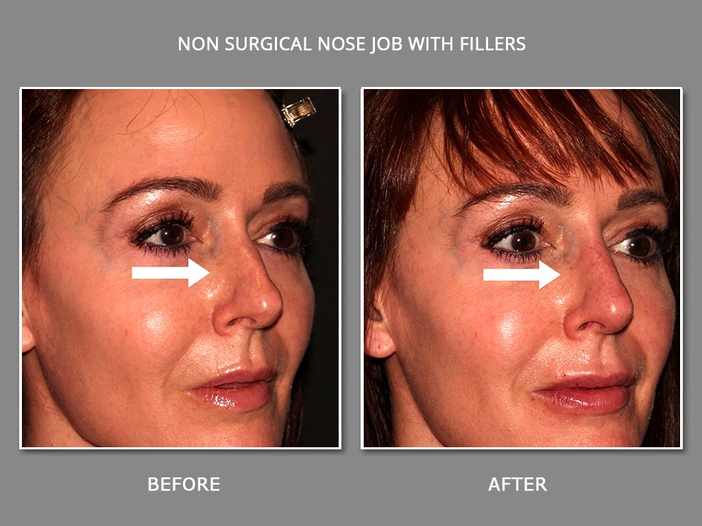 Alternatives to Plastic Surgery - A Guide Detailing Your Options in 2020