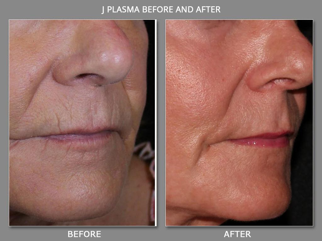 Renuvion - powered by J Plasma | Hitting the reset button on your skin