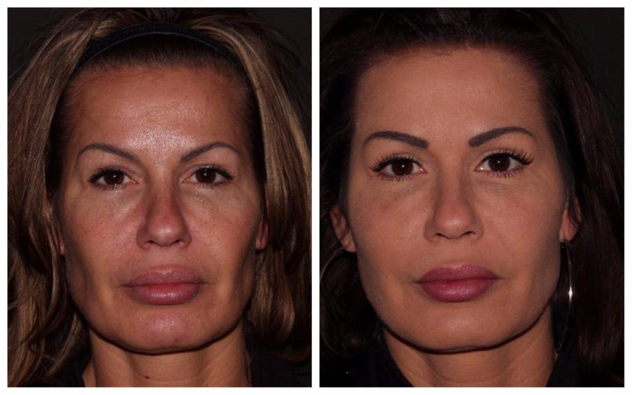 Fat Transfer & Grafting Dermal Filler | Broomfield & Denver